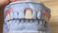 China Lightweight Comfortable Discreet Appearance Flexible Removable Denture and Invisible Removable Denture Base for sale