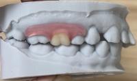 China Lightweight Comfortable Discreet Appearance Flexible Removable Denture and Invisible Removable Denture Base for sale