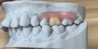 China Lightweight Comfortable Discreet Appearance Flexible Removable Denture and Invisible Removable Denture Base for sale