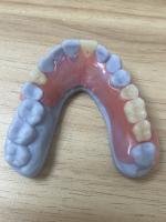 China Lightweight Comfortable Discreet Appearance Flexible Removable Denture and Invisible Removable Denture Base for sale