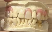 China Lightweight Comfortable Discreet Appearance Removable Denture Base and Flexible Denture Base for Esthetic Partial Dentures for sale