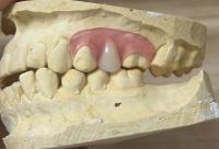 China Lightweight Comfortable Discreet Appearance Removable Denture Base and Flexible Denture Base for Esthetic Partial Dentures for sale