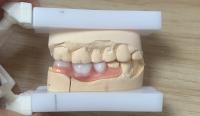 China Natural Appearance All-Zirconia Crown with Flexible Removable Denture Offering Flexible Fit and Lightweight Design for sale