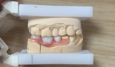 China Natural Appearance All-Zirconia Crown with Flexible Removable Denture Offering Flexible Fit and Lightweight Design for sale