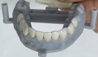 China Custom Fit Ceramic Veneers with Natural Appearance and Esthetic Finish for Dental Restorations for sale