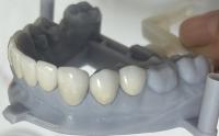 China Custom Fit Ceramic Veneers with Natural Appearance and Esthetic Finish for Dental Restorations for sale