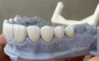 China Natural-Looking Esthetics Ceramic Veneers with Customized Tooth Shape and Precise Laboratory Fabrication for sale