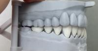 China Metal-Free Full Zirconia Dental Bridge with High Strength and Natural Appearance for Custom Zirconia Dental Bridge Restorations for sale