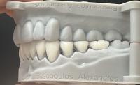 China Metal-Free Full Zirconia Dental Bridge with High Strength and Natural Appearance for Custom Zirconia Dental Bridge Restorations for sale