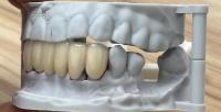 China Metal Framework Porcelain Aesthetics Functional Durability Porcelain-Fused-to-Metal Crown and PFM Dental Restoration for sale