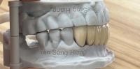 China Metal Framework Porcelain Aesthetics Functional Durability Porcelain-Fused-to-Metal Crown and PFM Dental Restoration for sale