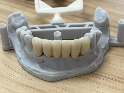 China Metal Framework Porcelain Aesthetics Functional Durability Porcelain-Fused-to-Metal Crown and PFM Dental Restoration for sale