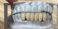 China Metal Framework Porcelain Aesthetics Functional Durability Porcelain-Fused-to-Metal Crown and PFM Dental Restoration for sale