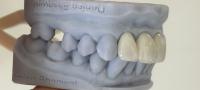 China Castable Ceramic Veneers with Natural Translucency and Customized Shape for Anterior Teeth Restoration for sale