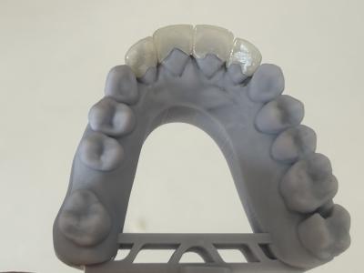 China Castable Ceramic Veneers with Natural Translucency and Customized Shape for Anterior Teeth Restoration for sale