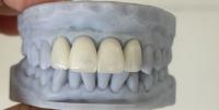 China Castable Ceramic Veneers with Natural Translucency and Customized Shape for Anterior Teeth Restoration for sale