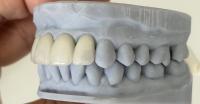 China Castable Ceramic Veneers with Natural Translucency and Customized Shape for Anterior Teeth Restoration for sale