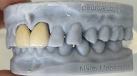 China Customized Zirconia Dental Restorations with CAD/CAM Digital Design and Natural Translucency Aesthetic Finish for Zirconia Crowns and Bridges for sale