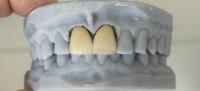 China Customized Zirconia Dental Restorations with CAD/CAM Digital Design and Natural Translucency Aesthetic Finish for Zirconia Crowns and Bridges for sale