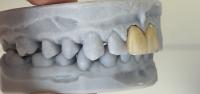 China Customized Zirconia Dental Restorations with CAD/CAM Digital Design and Natural Translucency Aesthetic Finish for Zirconia Crowns and Bridges for sale
