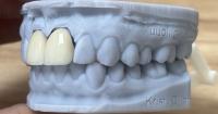 China Customized Zirconia Dental Restorations with CAD/CAM Digital Design and Natural Translucency Aesthetic Finish for Zirconia Crowns and Bridges for sale