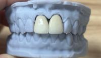 China Customized Zirconia Dental Restorations with CAD/CAM Digital Design and Natural Translucency Aesthetic Finish for Zirconia Crowns and Bridges for sale
