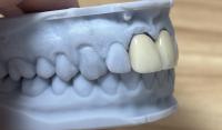 China Customized Zirconia Dental Restorations with CAD/CAM Digital Design and Natural Translucency Aesthetic Finish for Zirconia Crowns and Bridges for sale
