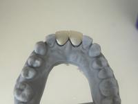 China Customized Zirconia Dental Restorations with CAD/CAM Digital Design and Natural Translucency Aesthetic Finish for Zirconia Crowns and Bridges for sale