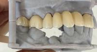 China Metal-Free Full Zirconia Dental Restoration with Wear Resistance and Natural Tooth Shades for Monolithic Zirconia Restoration for sale