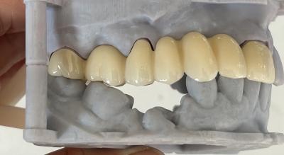 China Metal-Free Full Zirconia Dental Restoration with Wear Resistance and Natural Tooth Shades for Monolithic Zirconia Restoration for sale