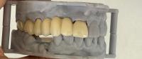 China Metal-Free Full Zirconia Dental Restoration with Wear Resistance and Natural Tooth Shades for Monolithic Zirconia Restoration for sale