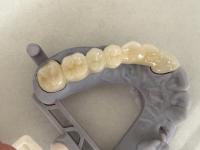 China Metal-Free Full Zirconia Dental Restoration with Wear Resistance and Natural Tooth Shades for Monolithic Zirconia Restoration for sale
