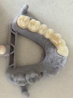 China Metal-Free Full Zirconia Dental Restoration with Wear Resistance and Natural Tooth Shades for Monolithic Zirconia Restoration for sale