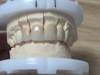 China Customized Zirconia Crown and Zirconia Dental Restoration with Natural Translucency and Aesthetic Finish Using CAD/CAM Digital Design and Milling for sale