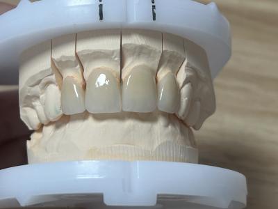 China Customized Zirconia Crown and Zirconia Dental Restoration with Natural Translucency and Aesthetic Finish Using CAD/CAM Digital Design and Milling for sale