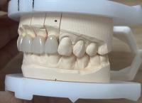 China Customized Zirconia Crown and Zirconia Dental Restoration with Natural Translucency and Aesthetic Finish Using CAD/CAM Digital Design and Milling for sale