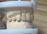 China Customized Zirconia Crown and Zirconia Dental Restoration with Natural Translucency and Aesthetic Finish Using CAD/CAM Digital Design and Milling for sale
