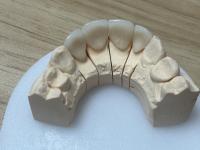 China Customized Zirconia Crown and Zirconia Dental Restoration with Natural Translucency and Aesthetic Finish Using CAD/CAM Digital Design and Milling for sale