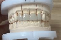 China Customized Zirconia Crown and Zirconia Dental Restoration with Natural Translucency and Aesthetic Finish Using CAD/CAM Digital Design and Milling for sale