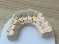 China Customized Zirconia Crown and Zirconia Dental Restoration with Natural Translucency and Aesthetic Finish Using CAD/CAM Digital Design and Milling for sale