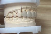China Customized Zirconia Crown and Zirconia Dental Restoration with Natural Translucency and Aesthetic Finish Using CAD/CAM Digital Design and Milling for sale