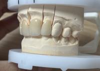 China Customized Zirconia Crown and Zirconia Dental Restoration with Natural Translucency and Aesthetic Finish Using CAD/CAM Digital Design and Milling for sale
