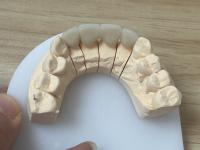 China Customized Zirconia Crown and Zirconia Dental Restoration with Natural Translucency and Aesthetic Finish Using CAD/CAM Digital Design and Milling for sale