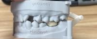 China Cobalt-Chromium PFM Crown and Porcelain-Fused-to-Metal Crown with Natural-Looking Porcelain Surface and Customized Design for sale
