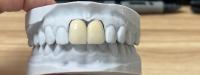 China Cobalt-Chromium Alloy Framework PFM Dental Crowns and Bridges with Customized Design Based on Digital Scan Files and Natural-Looking Porcelain Surface for sale