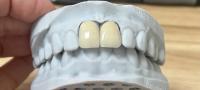 China Cobalt-Chromium Alloy Framework PFM Dental Crowns and Bridges with Customized Design Based on Digital Scan Files and Natural-Looking Porcelain Surface for sale