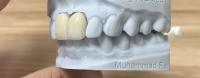 China Cobalt-Chromium Alloy Framework PFM Dental Crowns and Bridges with Customized Design Based on Digital Scan Files and Natural-Looking Porcelain Surface for sale