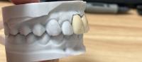 China Cobalt-Chromium Alloy Framework PFM Dental Crowns and Bridges with Customized Design Based on Digital Scan Files and Natural-Looking Porcelain Surface for sale