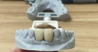 China Cobalt-Chromium Alloy Framework PFM Dental Crowns and Bridges with Customized Design Based on Digital Scan Files and Natural-Looking Porcelain Surface for sale