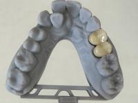 China Co-Cr Crown and Cobalt-Chromium PFM Crown for sale